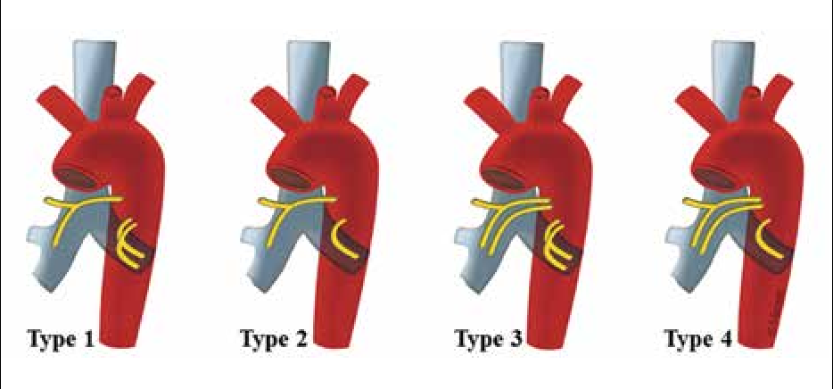 Bronchial Arterial Embolization (BAE) – Dr Konika